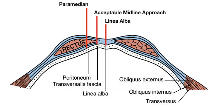 Identifying The Linea Alba Avoiding Paramedian Incisions During Identifying The Linea Alba Avoiding Paramedian Incisions During